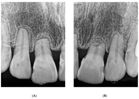 Is Inflammation A Friend Or Foe For Orthodontic Treatment