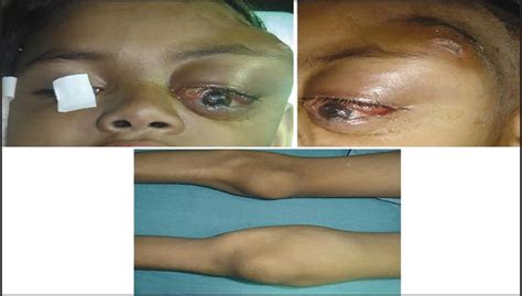 Osteosarcoma Metastasis To The Orbit Presenting As Severe Pr Journal Of Clinical