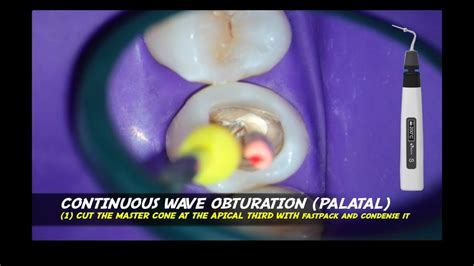New Endodontic Obturation Technique At Steven Hines Blog