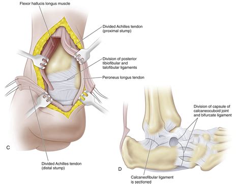45 Open Reduction Of Dorsolateral Dislocation Of The