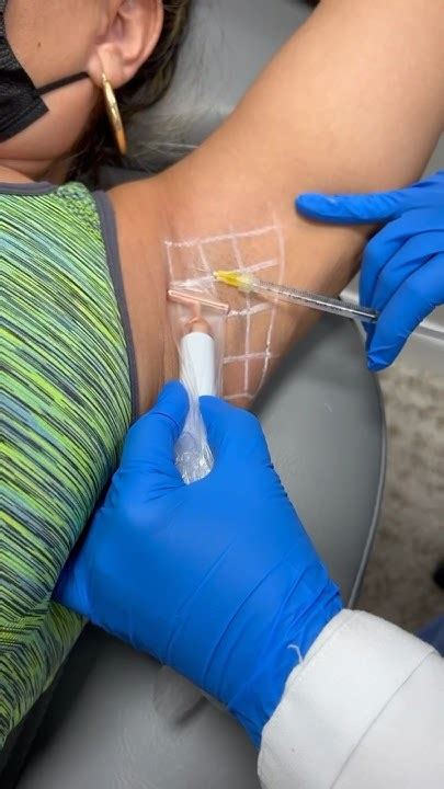 A Simple Solution For Hyperhidrosis Youtube