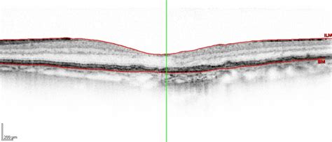 Anti Vegf Advancements Take Center Stage At Aao 2022 Ophthalmology Advisor