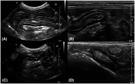Case Report Lymphocytic Plasmacytic And Eosinophilic Enterocolitis