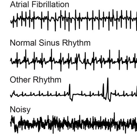 Pdf Towards Understanding Ecg Rhythm Classification Using Convolutional Neural Networks And