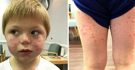 Mom Discovers Doctors Dangerous Mistake After Sons Sudden Full Body Rash Mom Discovers Doctors Dangerous Mistake After Sons Sudden Full Body Rash