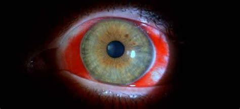 Derrame Ocular Hemorragia Nos Olhos Ou Sangue No Olho Vermelhidão
