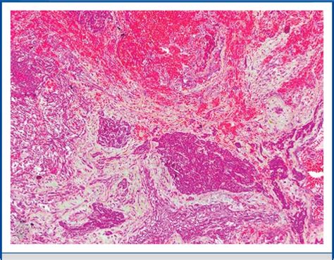 Figure 2 From Intraventricular Choroid Plexus Cavernoma Resection Using Tubular Retractor System