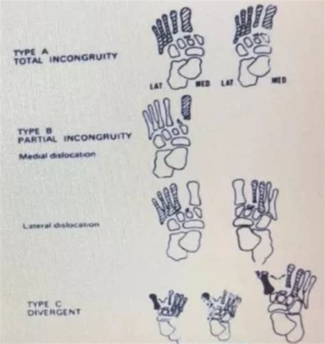 Lisfranc损伤的分型 德医学院 助力医学教育发展！