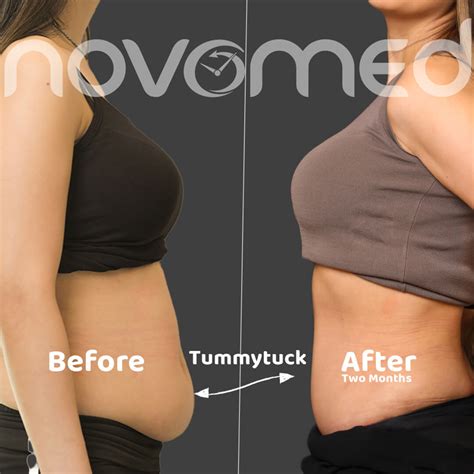 Transcranial Magnetic Stimulation TMS TMS In Dubai