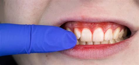 Common Causes Of White Gums And How To Get Rid Of It