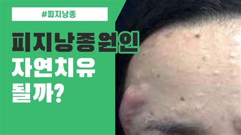 피지 낭종 자연치유 될까 피지낭종 제거 방법 Brainx