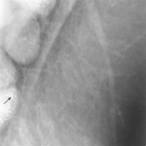 Ultrasound Image Showing Axillary Lymph Node Calcification Arrow Download Scientific Diagram