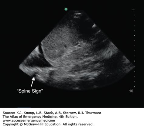 Main Lobar Fissure Ultrasound