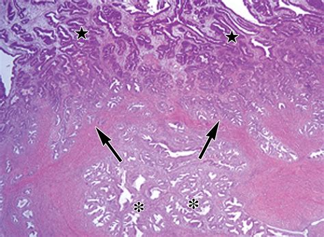 Mr Imaging Findings Of Adenomyosis Correlation With Histopathologic