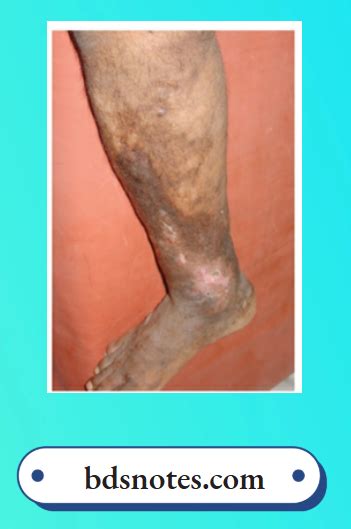 Varicose Veins And Deep Vein Thrombosis Notes Bds Notes