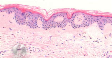 Primary Cutaneous Amyloidosis Pathology Image