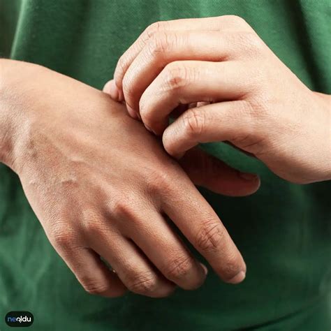 Eritema Multiforme Nedir Nedenleri Belirtileri Ve Tedavisi