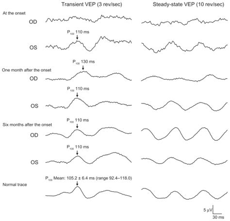 Pattern Visual Evoked Potentials Veps At The Onset Pattern Veps Are Download Scientific