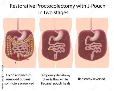 Restorative Proctocolectomy With J Pouch In Two Stages Stock