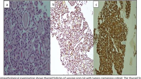 Figure 1 From A Rare Presentation Of Ectopic Thyroid Gland At Right Axilla Semantic Scholar