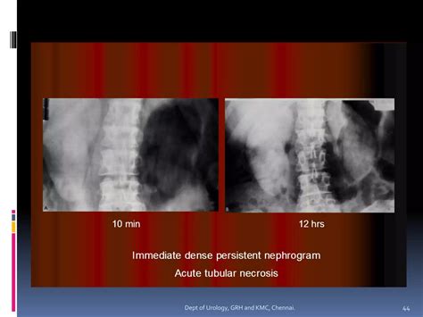 Intravenous Urography 1 Ppt