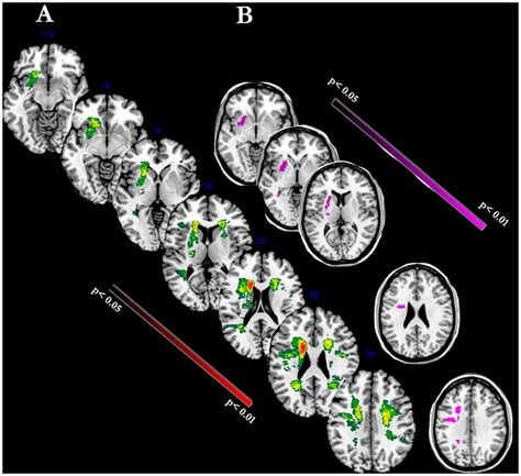 The Figure Represents Voxel Level Lesion Mapping Analysis Performed