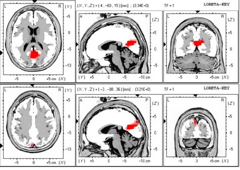 Loreta Alpha Power Results Source Localization Computed With Loreta Download Scientific Loreta Alpha Power Results Source Localization Computed With Loreta Download Scientific