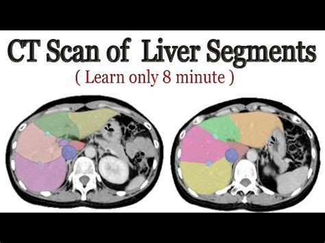 Liver Segments Axial Ct Master Couinaud Anatomy Guide