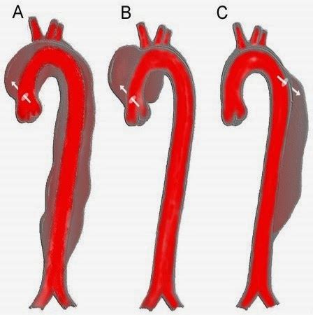 Medical Treatment Pictures For Better Understanding Aortic Dissection