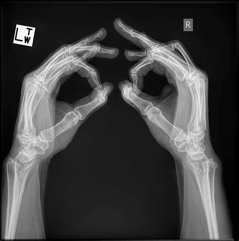 File Turner Syndrome Madelung Deformity Short 4th Metacarpal And