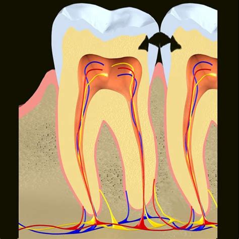 Interproximal Cavity Detection With X Rays Oh Be Careful Bite Point