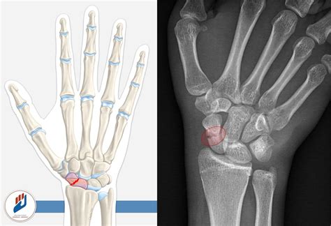 Fracture Du Scaphoïde à Bordeaux Clinique Du Sport