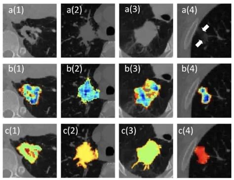 Automatic Lung Nodule Segmentation And Intra Nodular Heterogeneity Image Generation Mars Huang