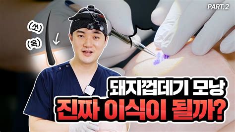 비절개 모발이식 어떻게 수술 진행나요 Feat 돼지껍데기 Youtube