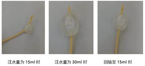 患者插了尿管老漏尿教你一个小技巧摆脱漏尿 气囊 护理 ml