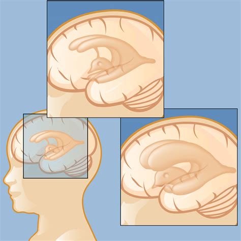 Hydrocephalus Neurological Surgery
