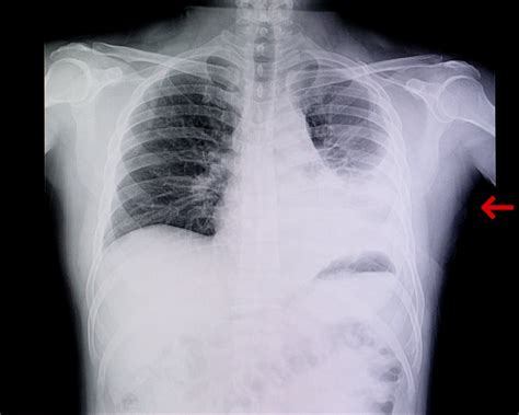 The Role Of Chest X Rays In Diagnosing Pneumonia