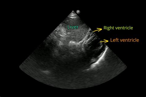 Focused Cardiac Ultrasound For The Nephrologist The 43 Off