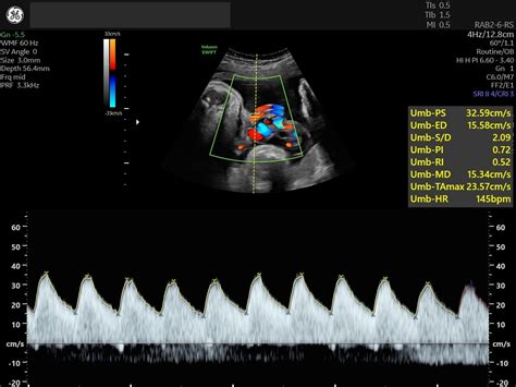 Umbilical Artery Doppler Assessment A How To Guide Empowered Womens
