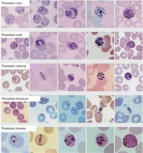 Plasmodium Agent Du Paludisme Classification Manifestations