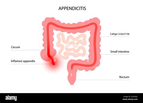 Inflamed Appendix Conceptual Illustration Stock Photo Alamy