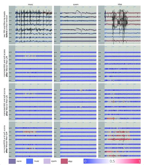 Qualitative Comparison Of Wiener Filters On Real Eeg Contaminated With Download Scientific