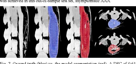 Figure 1 From 3d Segmentation Of Abdominal Aortic Aneurysm Walls From Ct Angiograms Semantic