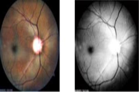 figure 2 from microaneurysms and exudates detection in retinal images