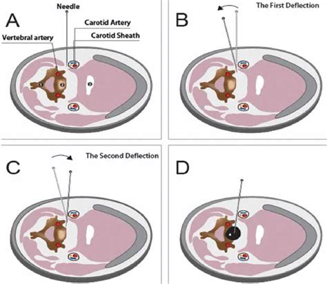 Pvp Procedure Using A Ct Guided Translateral Approach Via The Space Pvp Procedure Using A Ct Guided Translateral Approach Via The Space