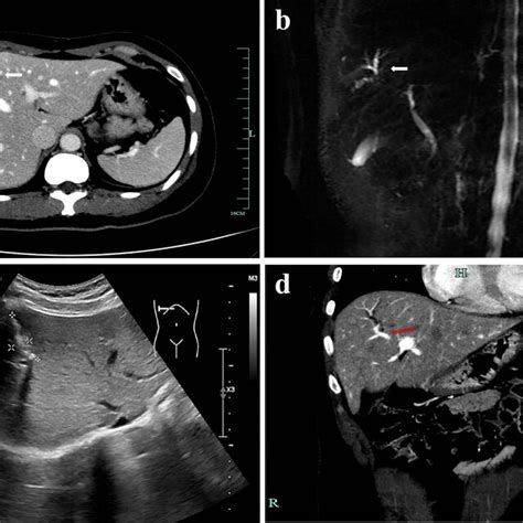 A Preoperative Computed Tomography Imaging Revealed Localized Download Scientific Diagram
