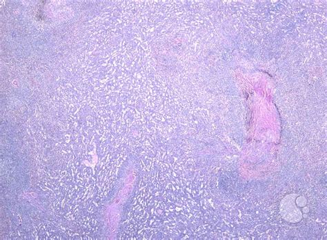 Autoimmune Lymphoproliferative Syndrome 1