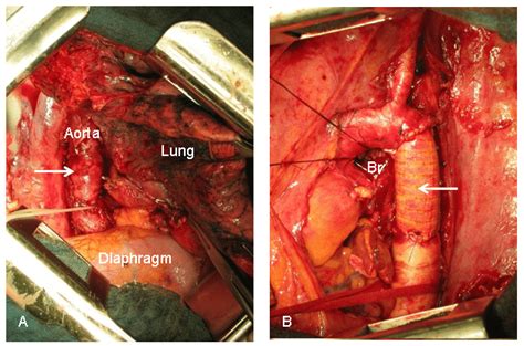 Operative View A Tumor Removed From The Descending Aorta By Download Scientific Diagram