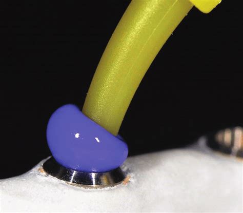 Extrusion Of Excess Impression Material Figure 3 Extruded Excess Download Scientific Diagram