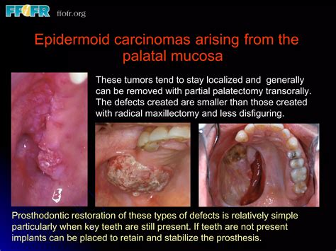 10 Etiology Of Palatal And Paranasal Sinus Defects Ppt Ear Nose